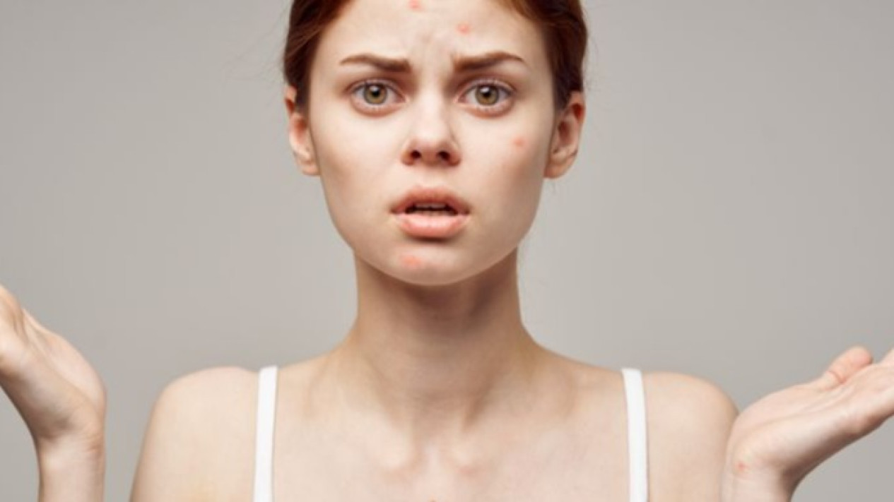 Foto Pipi, Dagu, atau Dahi? Lokasi Jerawat Bisa Kasih Clue Masalah ...