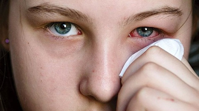 Cara Simpel Mengatasi Mata Bengkak Karena Menangis, Nomor 3 Bikin Kaget!