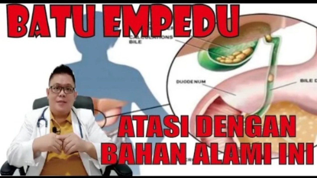 Batu Empedu Bisa Luruh Tanpa Operasi? Coba 3 Ramuan Alami Ini, Dokter ...