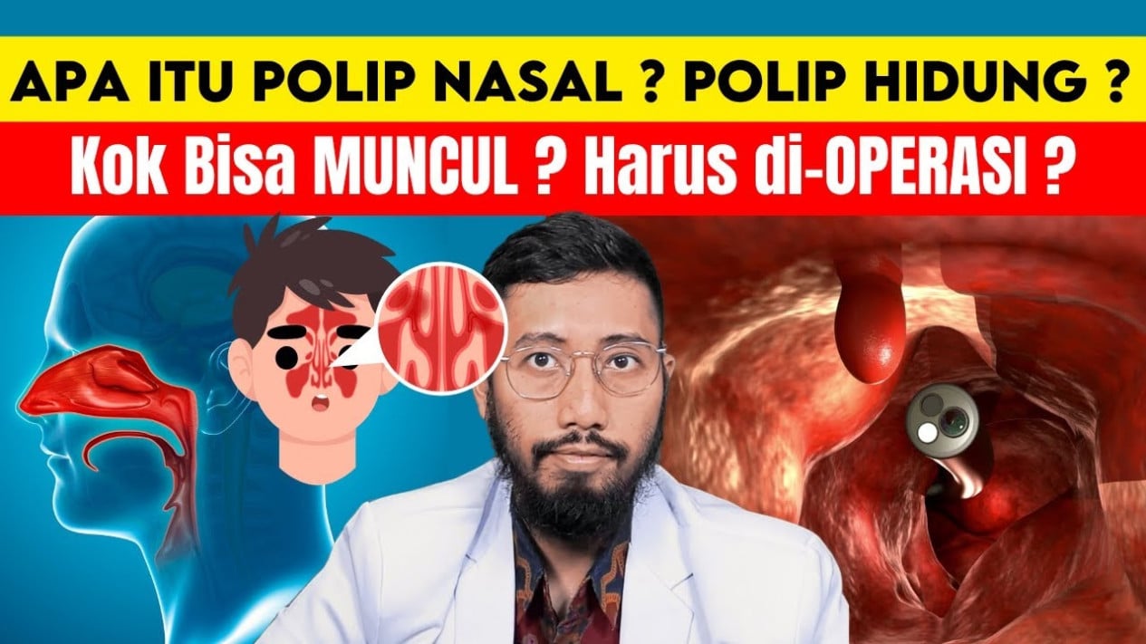 Hidung Mampet Terus dan Sering Bersin? Hati-Hati Bisa Jadi Polip Hidung