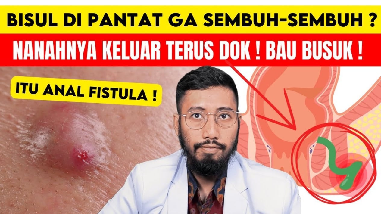 Bisul di Pantat Tidak Kunjung Sembuh dan Keluar Nanah Terus? Hati-Hati ...