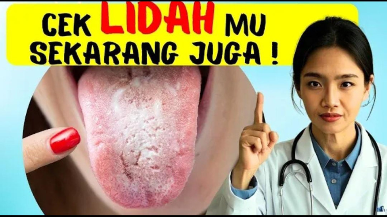 Bahaya! Kenali 9 Tanda di Lidah yang Jadi Gejala Penyakit Serius Jangan ...