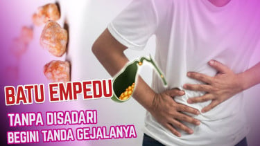 Batu Empedu Bisa Luruh Tanpa Operasi? Coba 3 Ramuan Alami Ini, Dokter ...