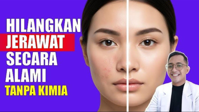 Gak Cuma Soal Kulit! Ini 4 Rahasia Alami Basmi Jerawat Bandel Sampai ke ...