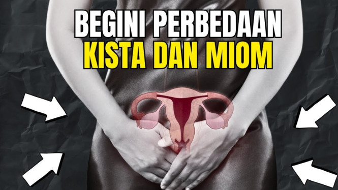 Rahasia Dokter, Ini Perbedaan Kista dan Miom yang Jarang Dijelaskan ke Pasien!