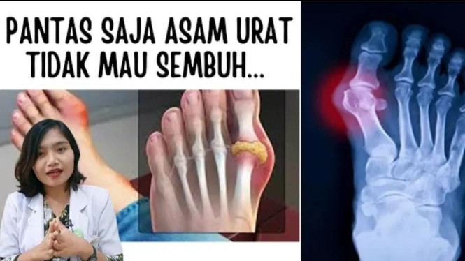 Asam Urat Tak Kunjung Turun? Ini 3 Sumber Kenaikan Asam Urat dan Kunci ...