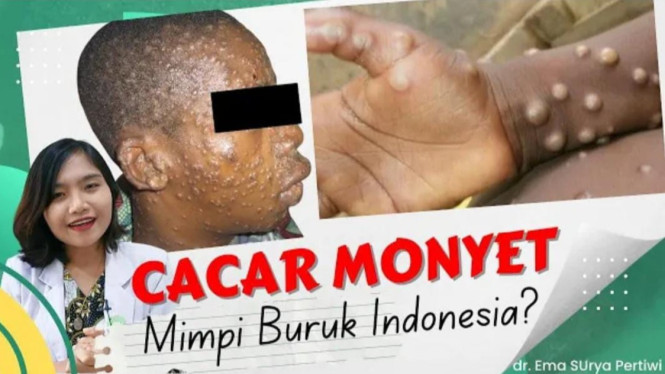 Monkeypox Masuk Indonesia! Kenali Gejala, Cara Penularan, dan Bedanya ...